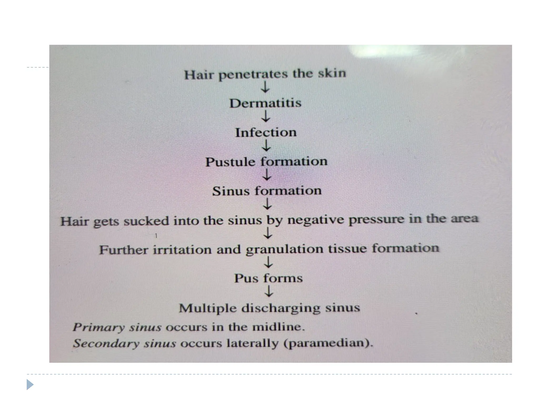 Pilonidal Sinus Definition types history examination treatment | PPT