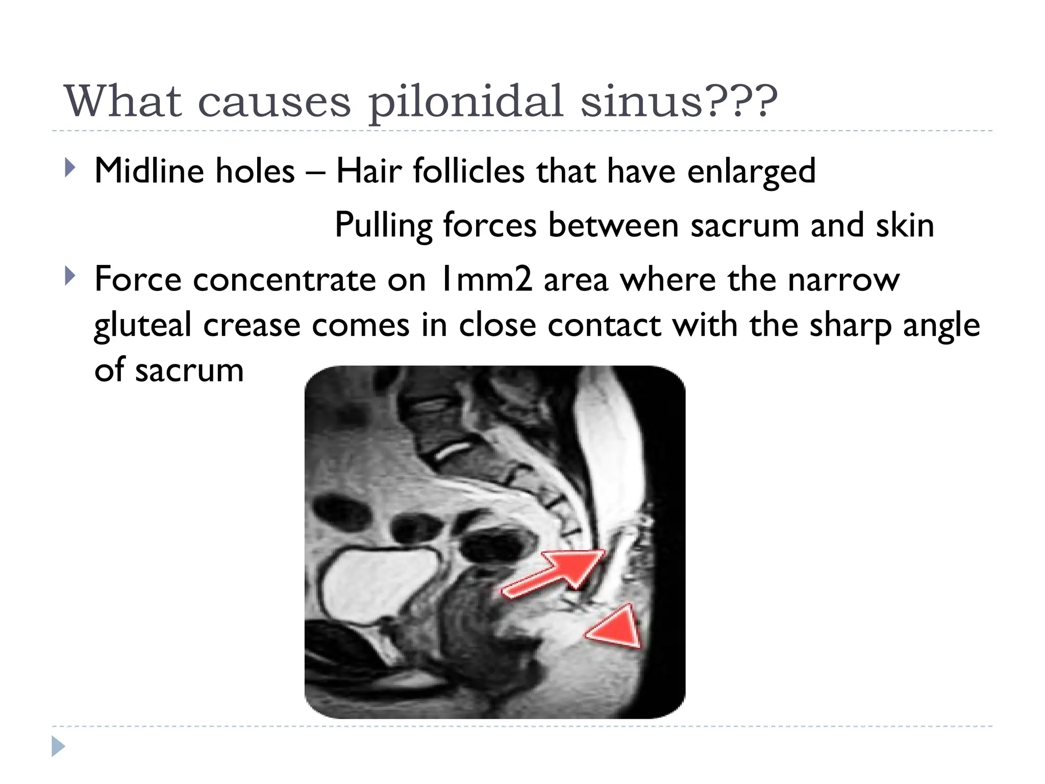 Pilonidal Sinus Definition types history examination treatment | PPT