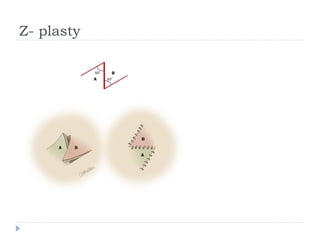 Pilonidal Sinus Definition types history examination treatment | PPT