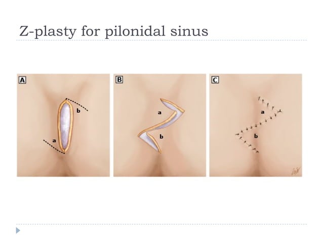 Pilonidal Sinus Definition types history examination treatment | PPT