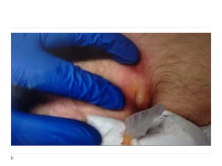 Pilonidal Sinus Definition types history examination treatment | PPT