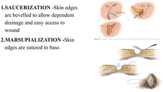 PILONIDAL SINUS ETIOLOGY DIAGNOSIS TREATMENT .pptx