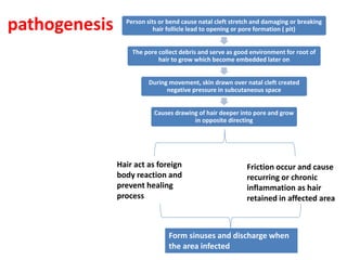 Pilonidal sinus | PPTX