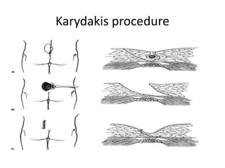 Pilonidal sinus 19 AUG 22.pptx