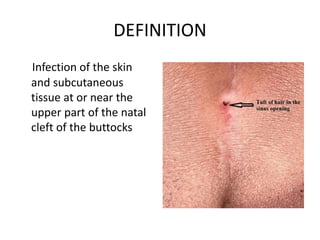 Pilonidal sinus 19 AUG 22.pptx