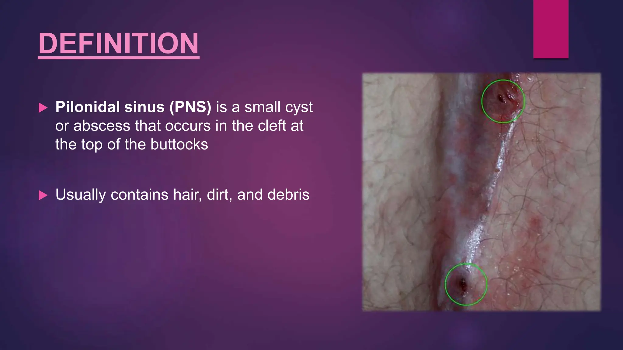 Pilonidal sinus diagnosis and management (colorectal surgery) | PPTX