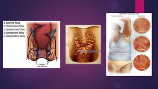 Pilonidal sinus diagnosis and management (colorectal surgery) | PPTX