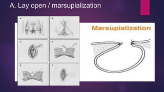 Pilonidal sinus diagnosis and management (colorectal surgery) | PPTX
