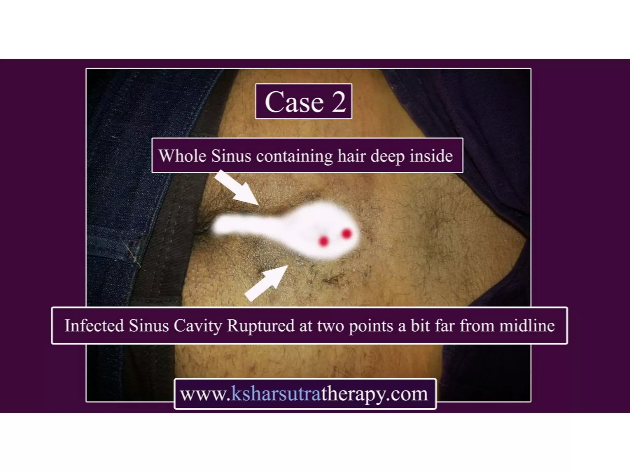 Pilonidal Sinus : Common Presentations with original pictures | PDF