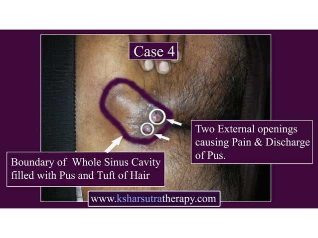 Pilonidal Sinus : Common Presentations with original pictures | PDF ...
