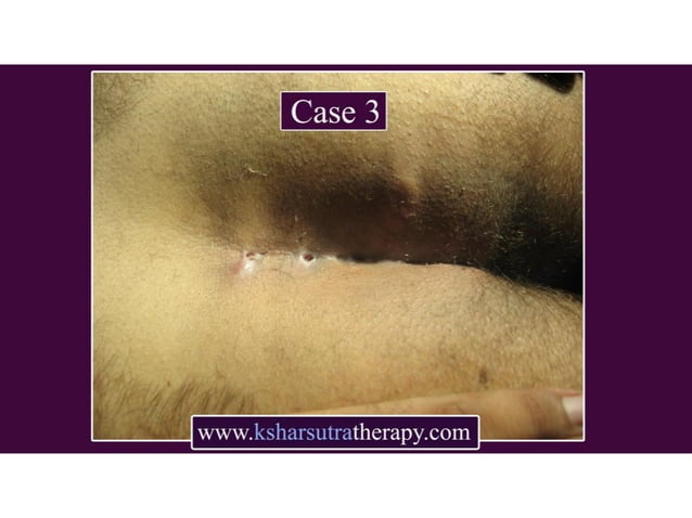 Pilonidal Sinus : Common Presentations with original pictures | PDF ...