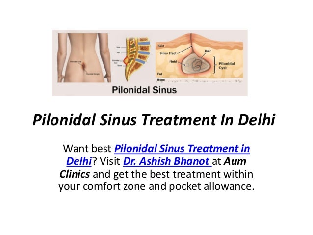 Best Doctor For Pilonidal Sinus Delhi Ncr