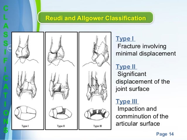 pilon fractures or " plafond