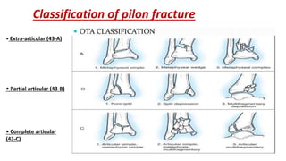 Pilon fracture | PPTX
