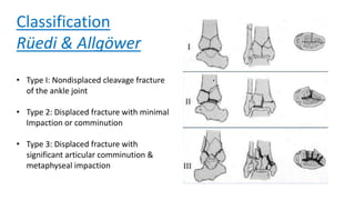 Pilon fracture | PPTX