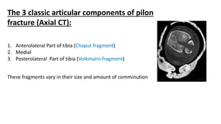 Pilon fracture | PPTX