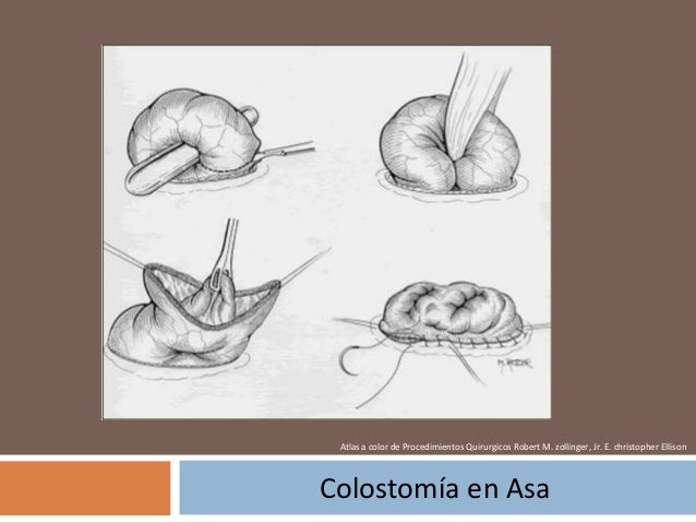 Piloroplastia, gastrostomia, yeyunostomia, ileostomia y colostomia.
