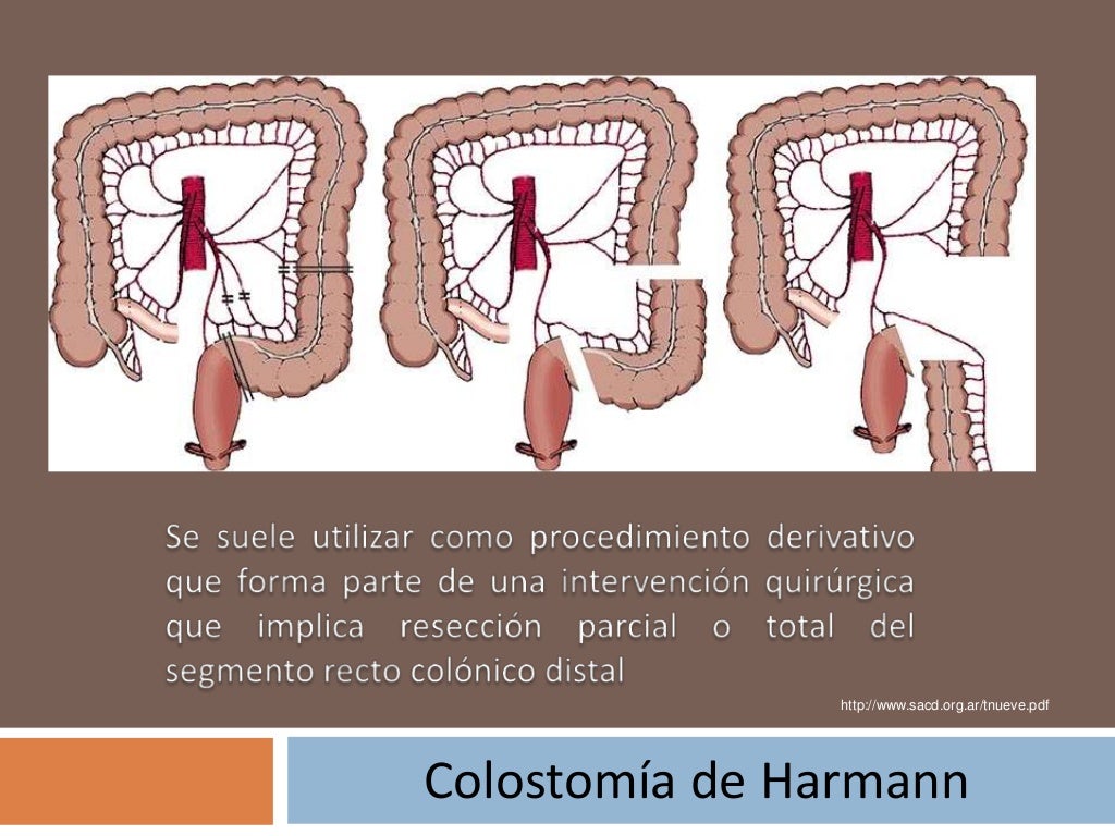 Piloroplastia Gastrostomia Yeyunostomia Ileostomia Y Colostomia Images