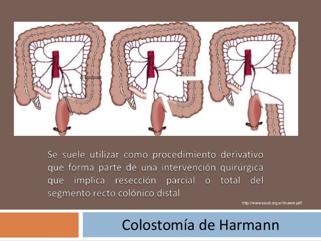 Piloroplastia, gastrostomia, yeyunostomia, ileostomia y colostomia.