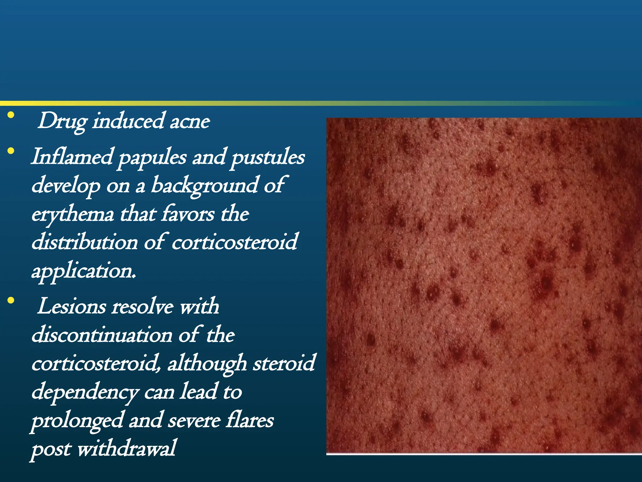 Pilosebaceous Disorders including Acne vulgaris | PPTX