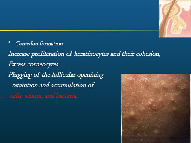 Pilosebaceous Disorders including Acne vulgaris | PPTX
