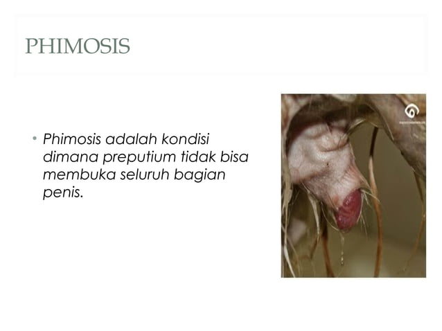 Pimosis dan parapimosis | PPT