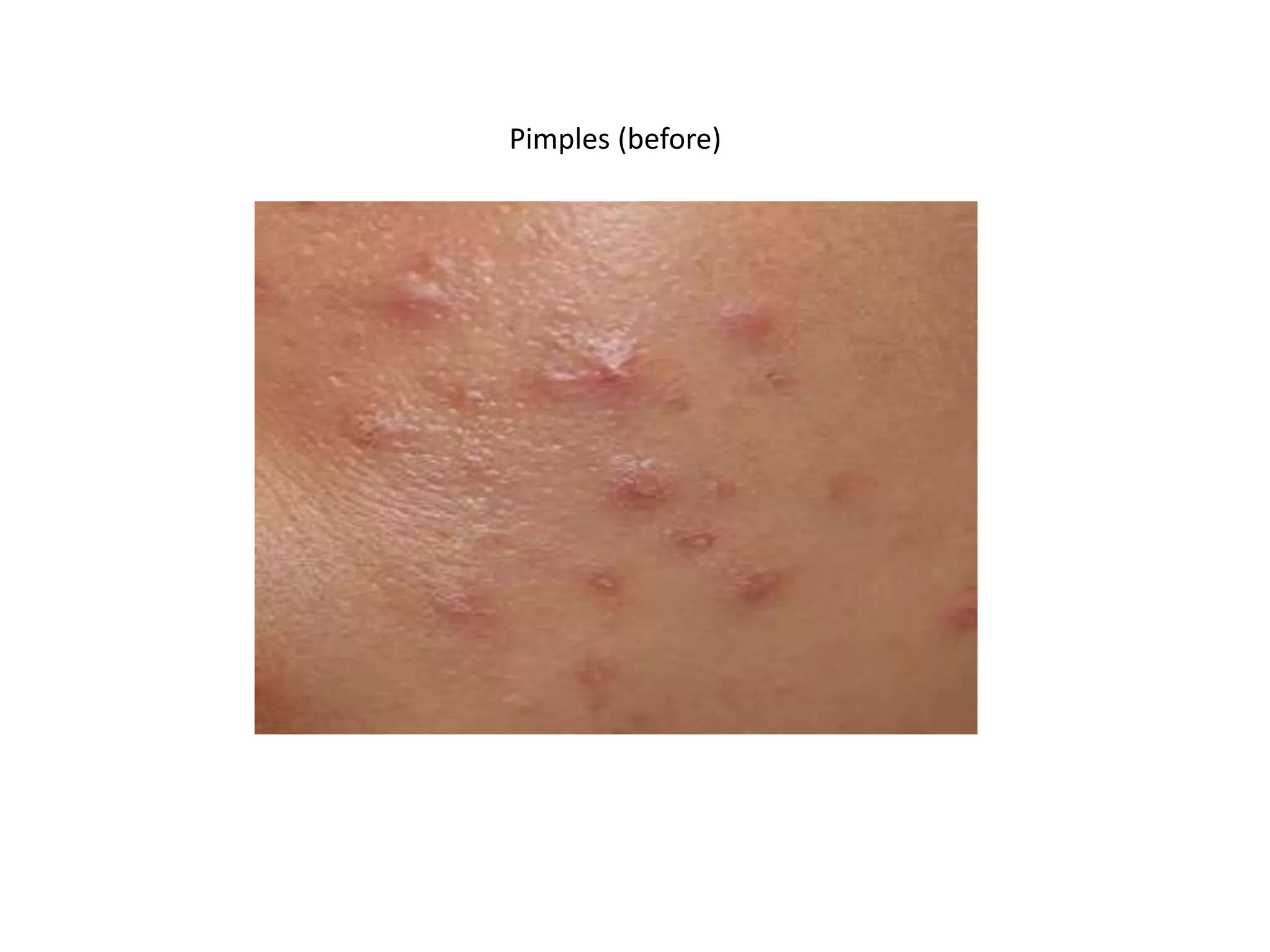 Pimple | PPT
