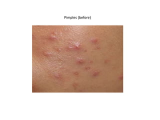 Pimple | PPT