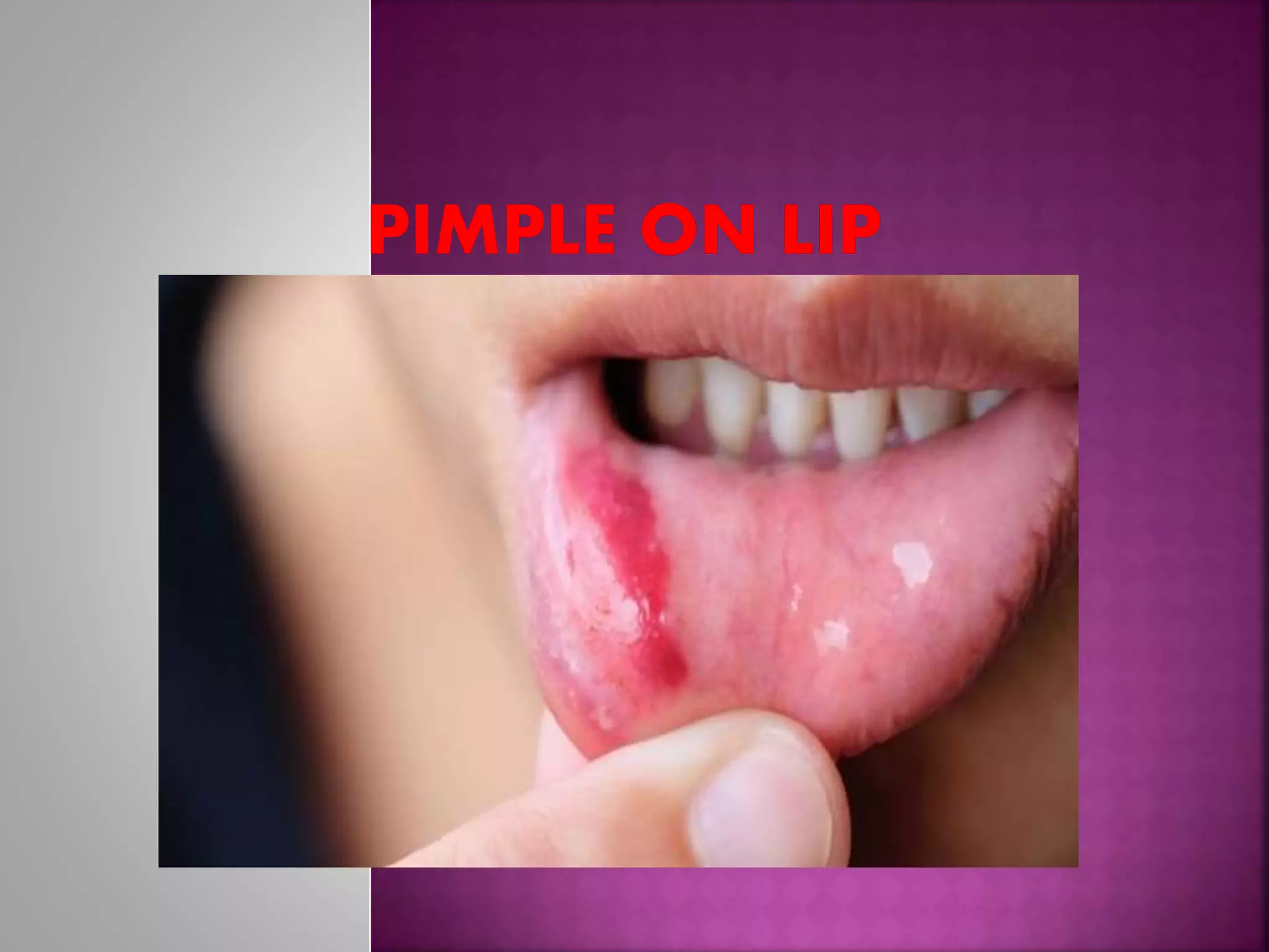 Pimple on lip 15 july 17 | PPTX