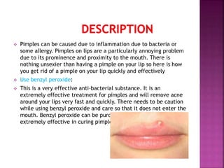 Pimple on lip 15 july 17 | PPTX