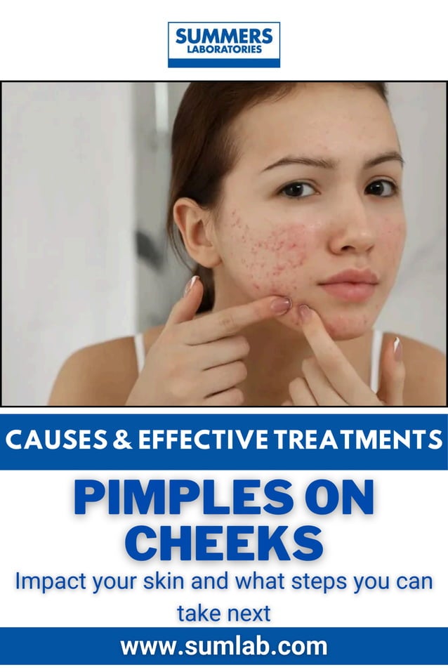 What are the best treatments for cheek pimples? | PDF