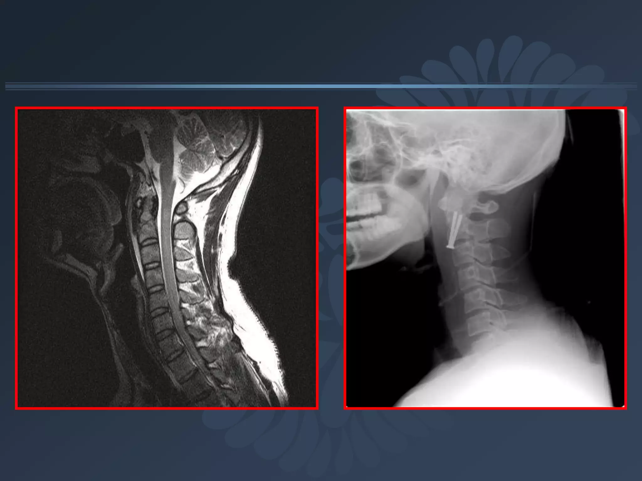 pinal cord injury.ppt