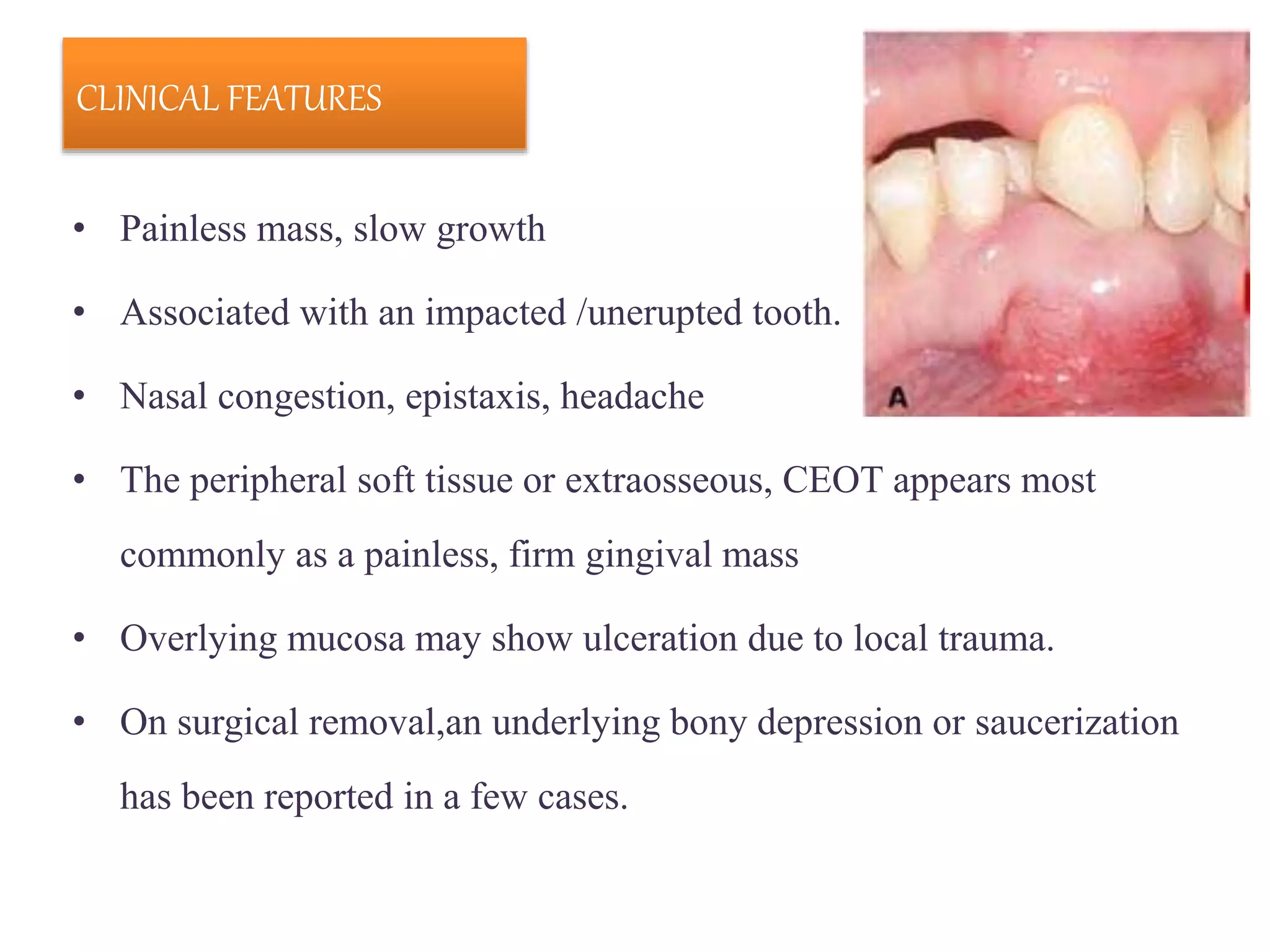 Pindborgs Tumour | PPTX