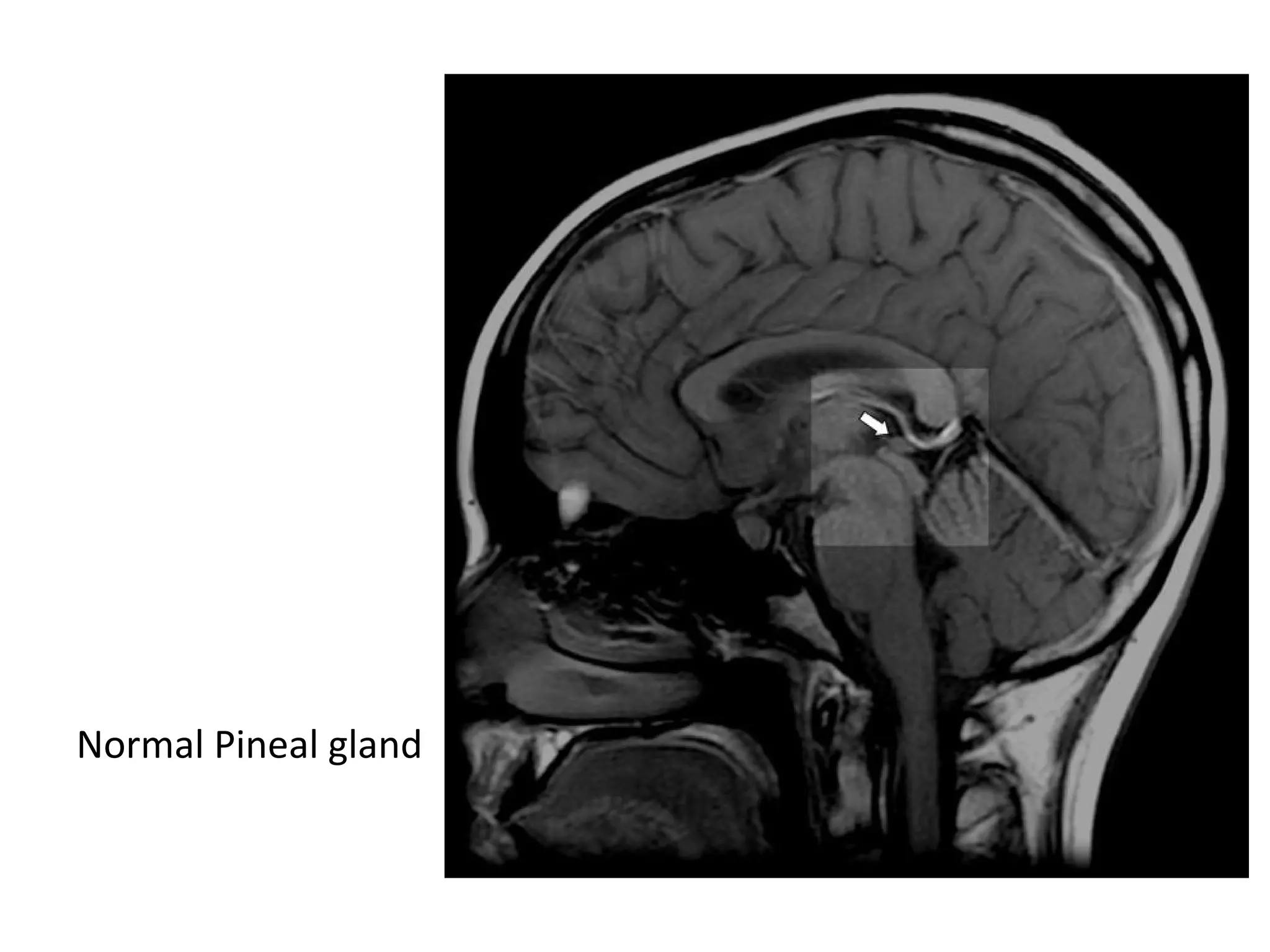 Diagnostic Imaging of Pineal Region Masses | PPT