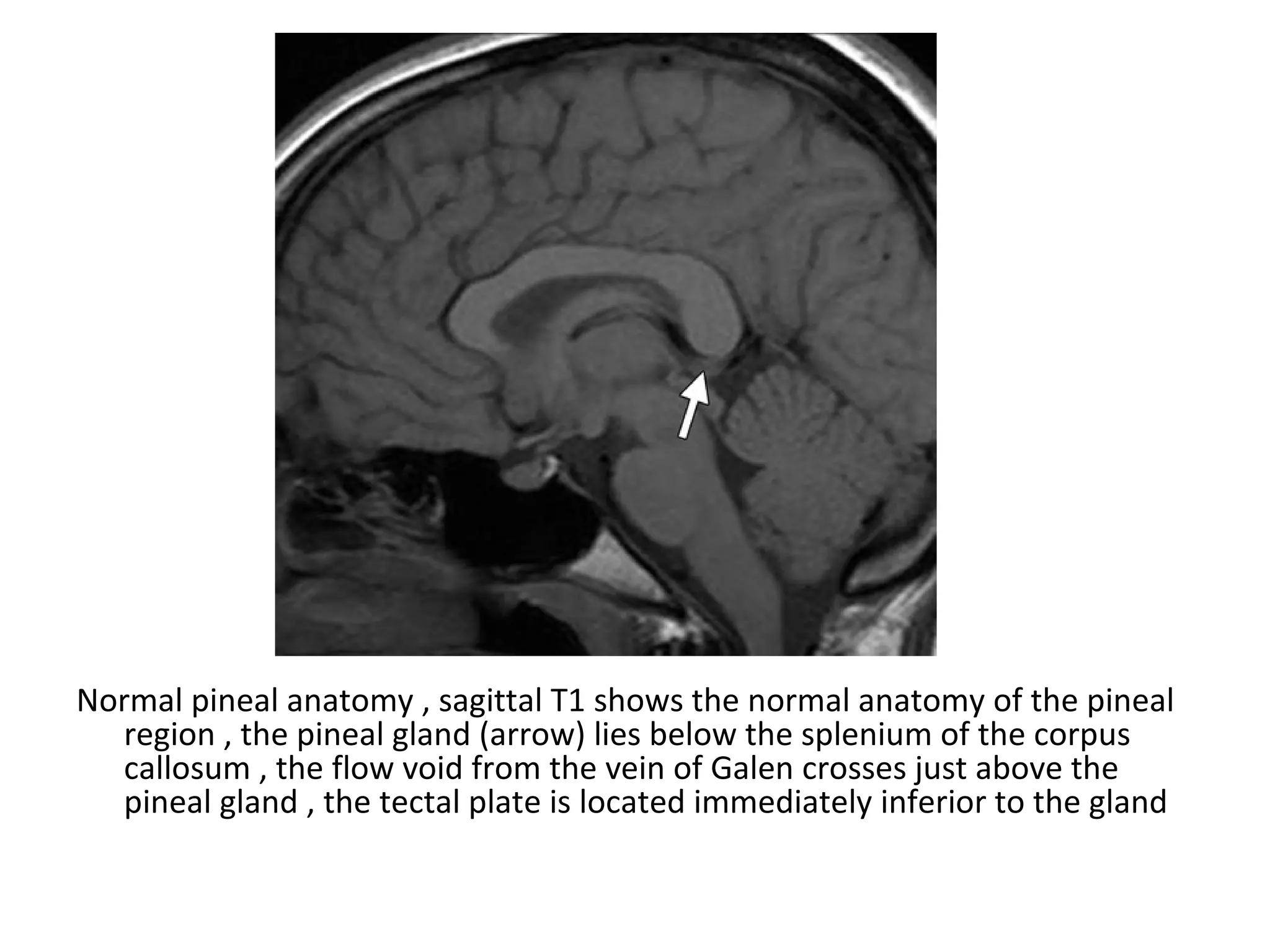 Diagnostic Imaging of Pineal Region Masses | PPT | Brain and Nervous ...