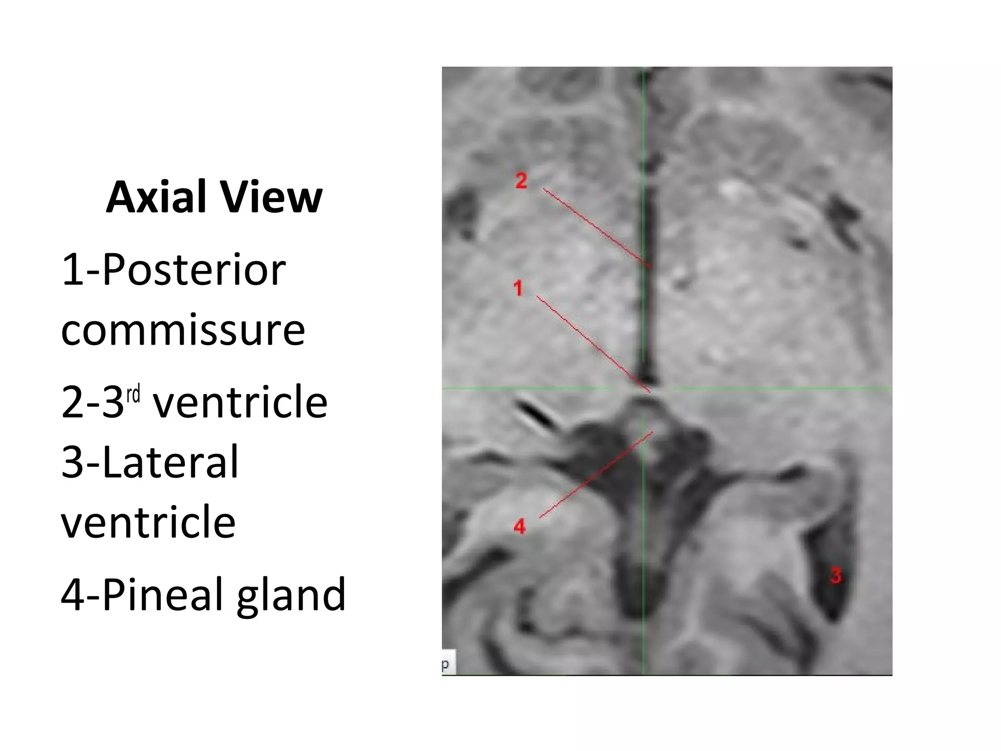Diagnostic Imaging of Pineal Region Masses | PPT