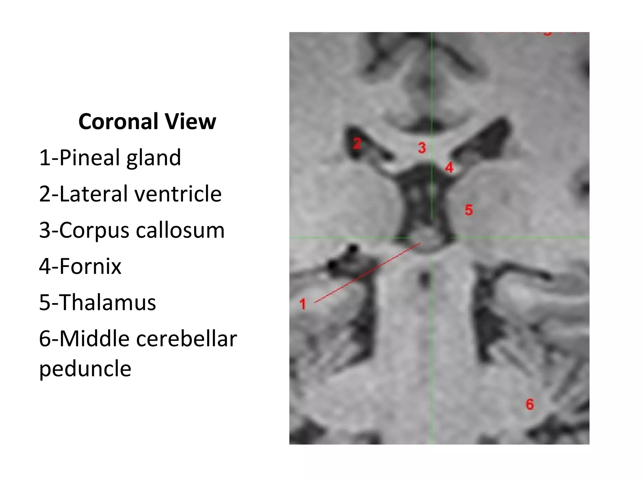 Diagnostic Imaging of Pineal Region Masses | PPT