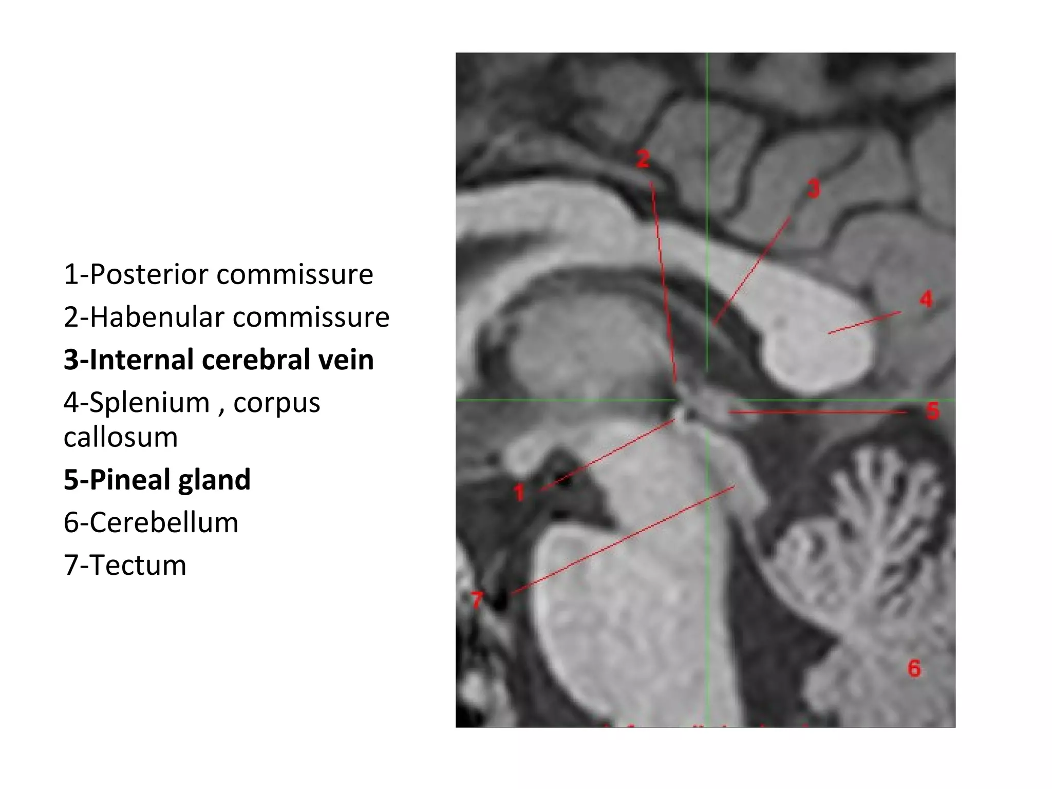 Diagnostic Imaging of Pineal Region Masses | PPT