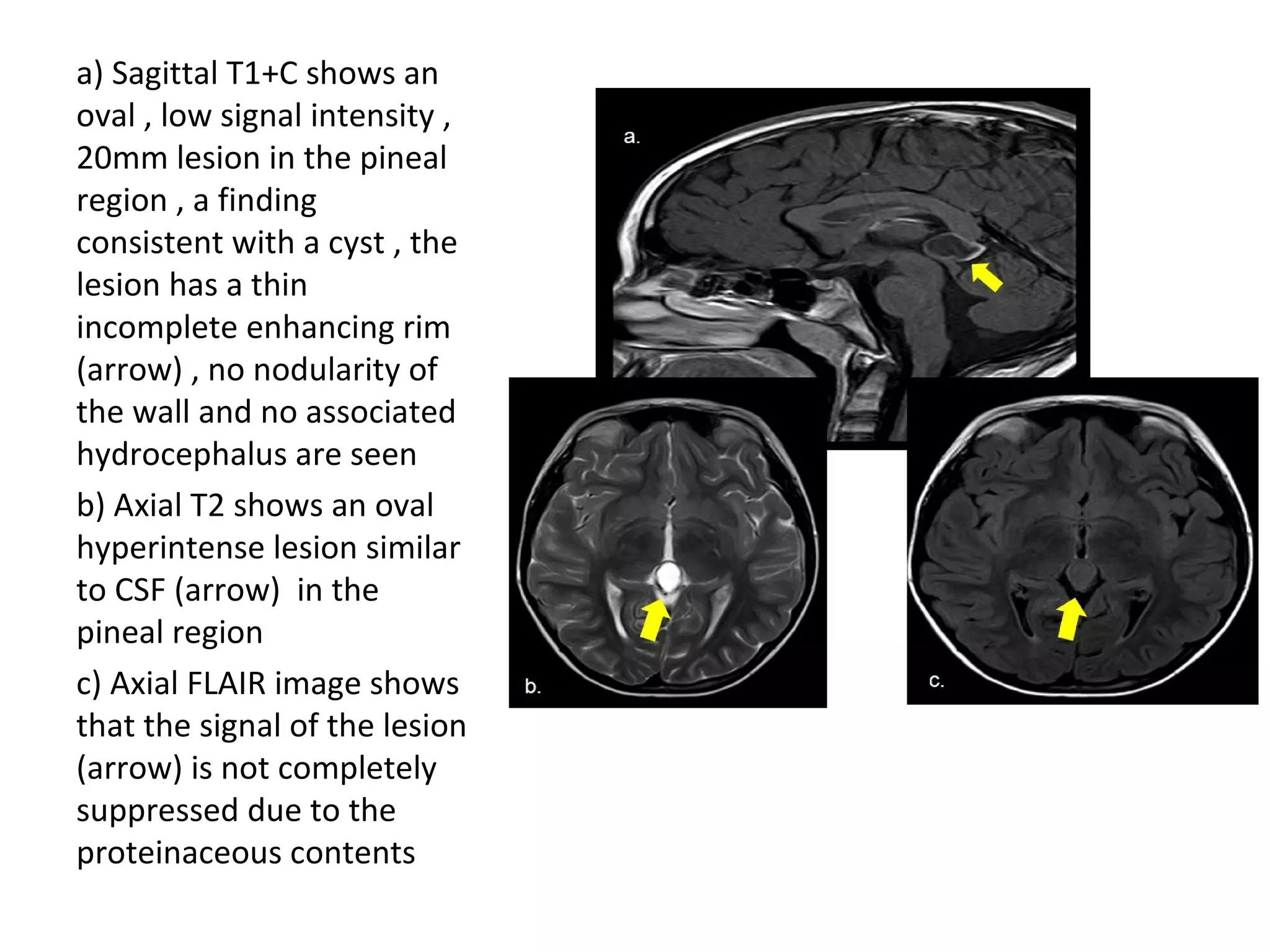 Diagnostic Imaging of Pineal Region Masses | PPT