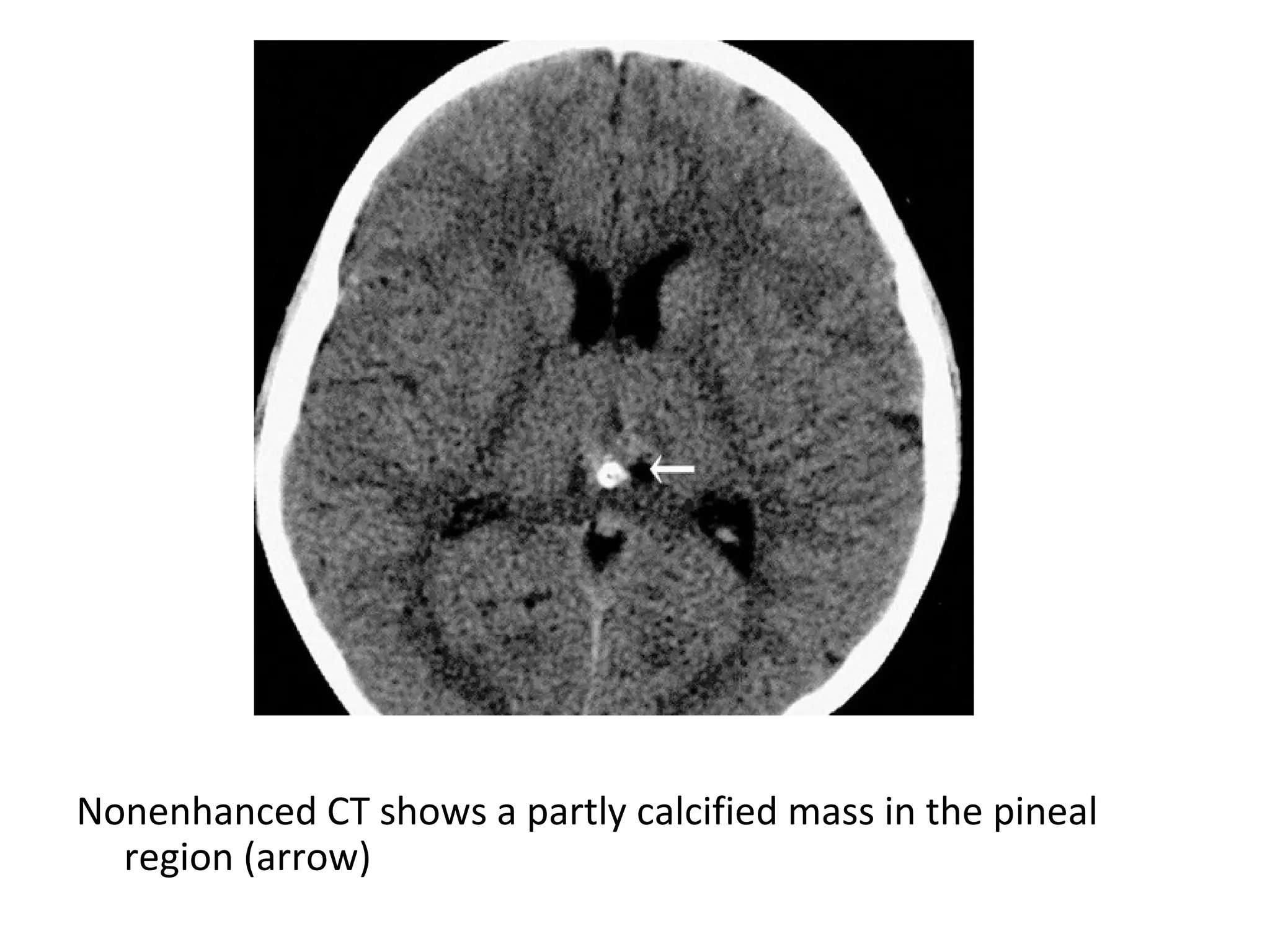 Diagnostic Imaging of Pineal Region Masses | PPT