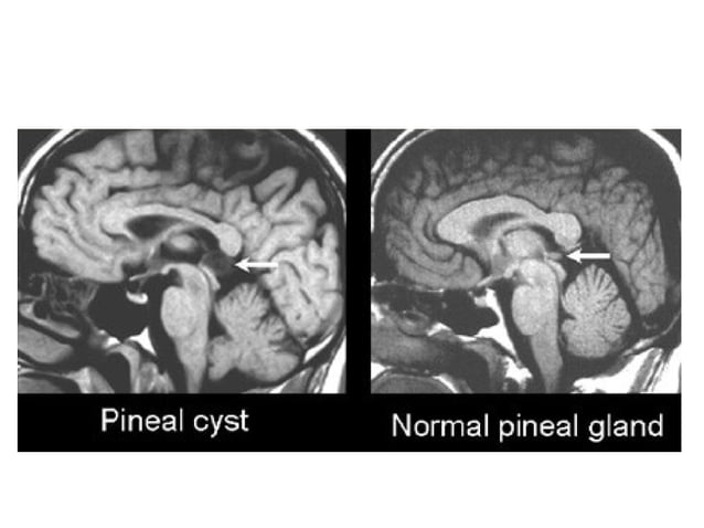 Diagnostic Imaging of Pineal Region Masses | PPT | Brain and Nervous ...