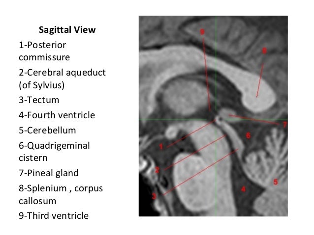Diagnostic Imaging of Pineal Region Masses