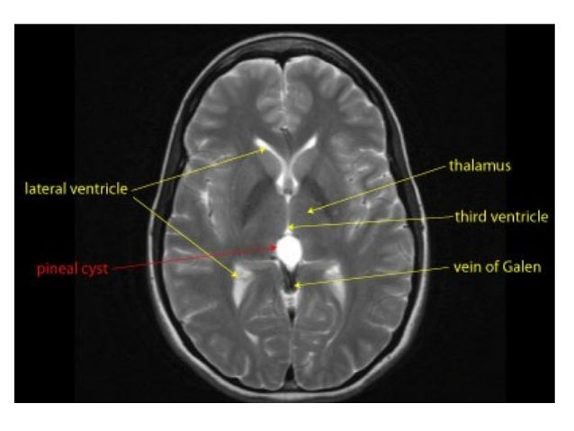 Diagnostic Imaging of Pineal Region Masses
