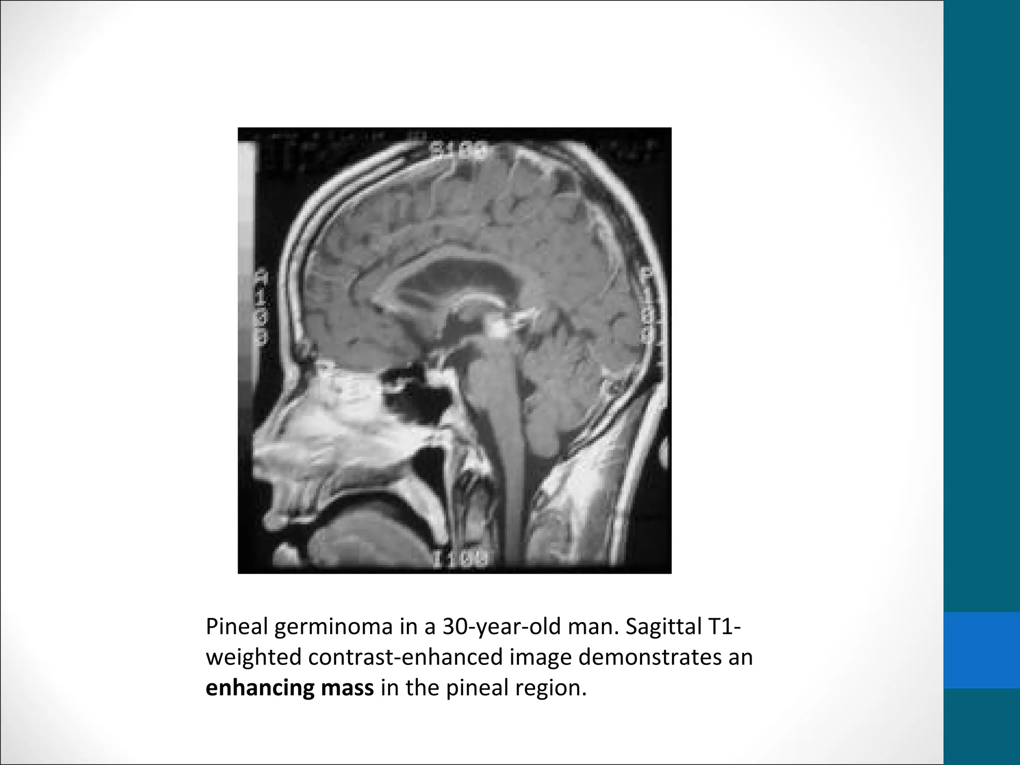 Pineal gland tumors | PPT