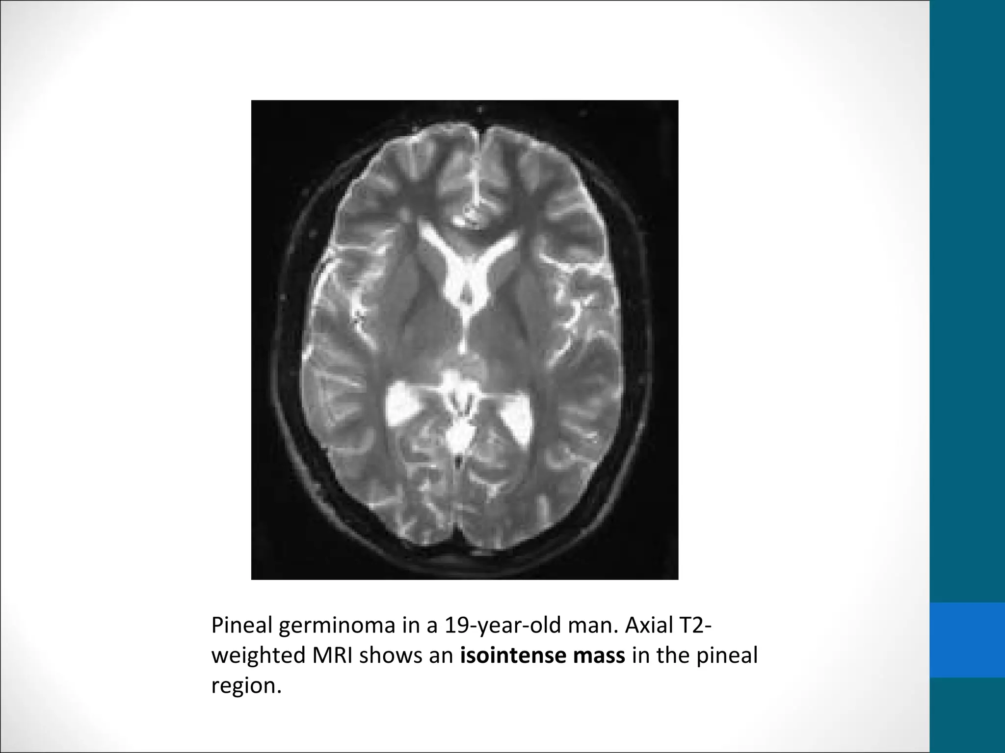 Pineal gland tumors | PPT