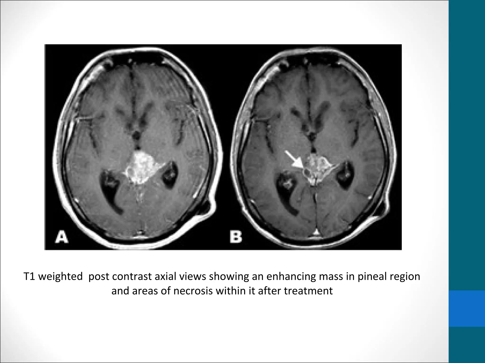 Pineal gland tumors | PPT
