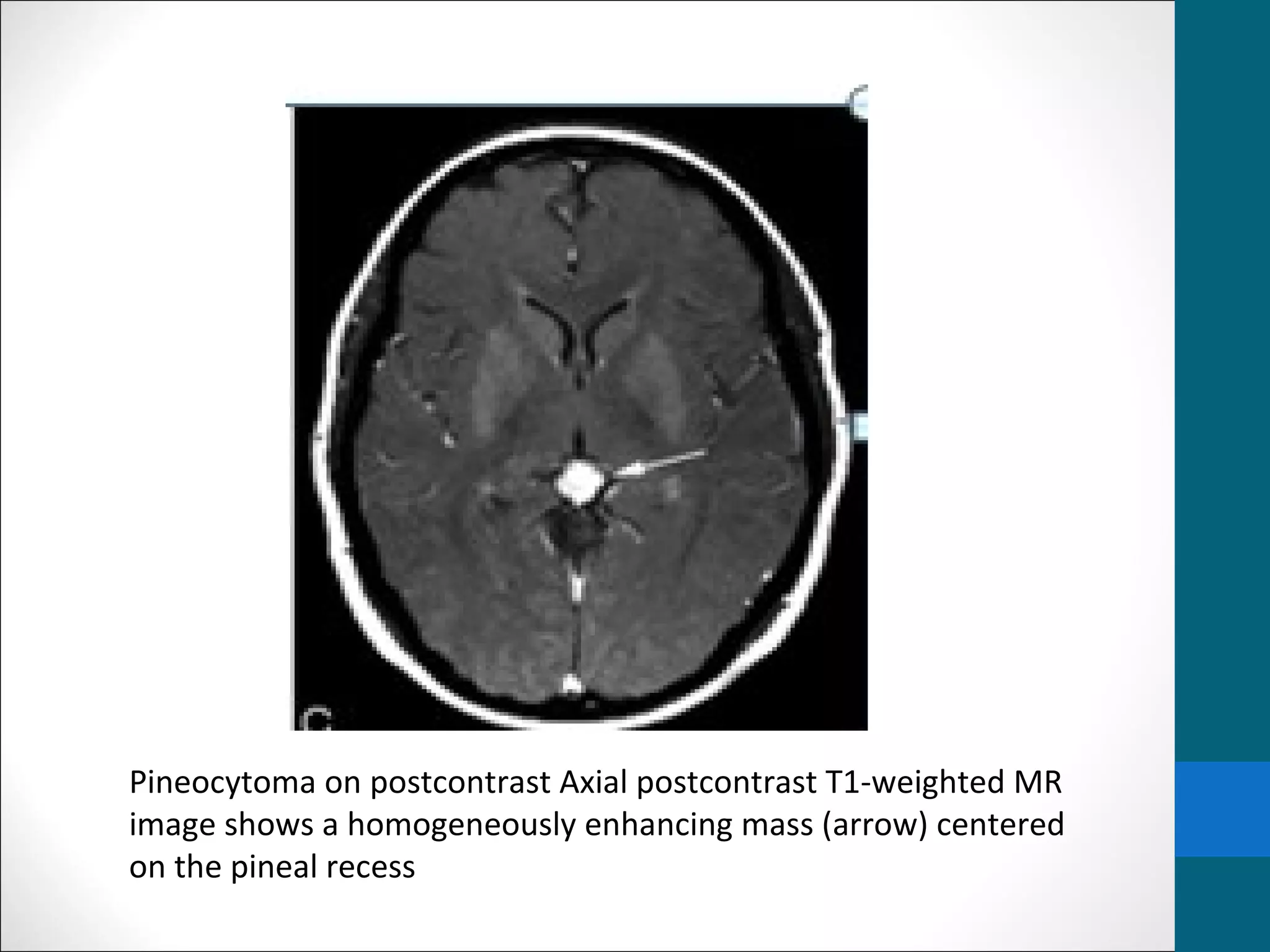 Pineal gland tumors | PPT
