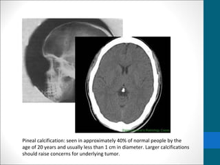 Pineal Gland Calcification