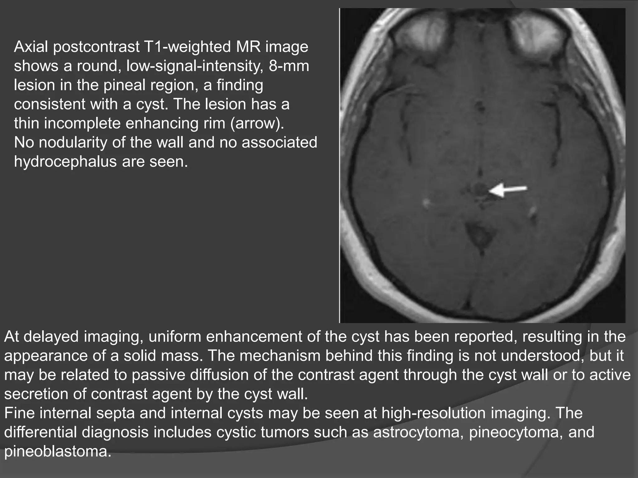 Pineal region masses - radiology | PPTX