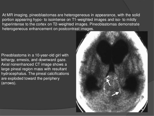 Pineal Region Masses Radiology